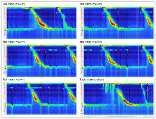 Gastric Belching: Diagnosis and Insights into Causes